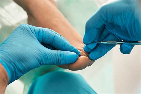 Ingrown Toenail Surgery Bunbury And Busselton