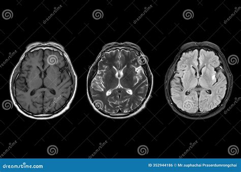 Mri Brain Scan Axial T1w T2w And Flair For Detect Brain Diseases Sush