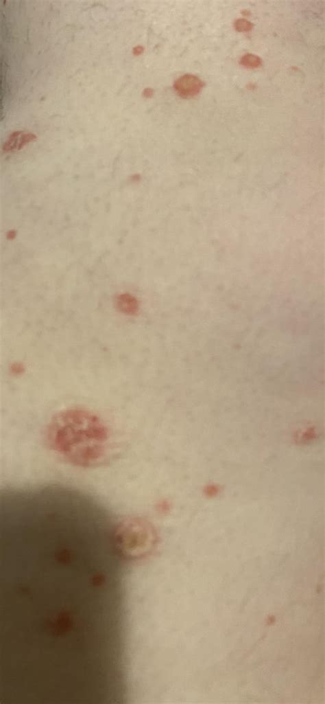 Dying My Hair Brought Back My Psoriasis Has This Happened To Anyone