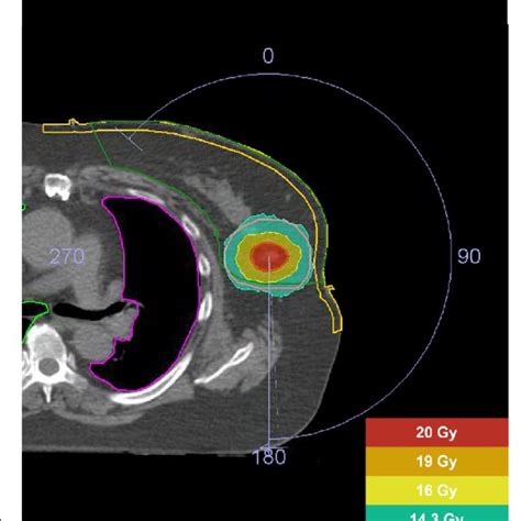 Dosimetry Treatment Plan Single Dose Ablative Radiotherapy Legend The