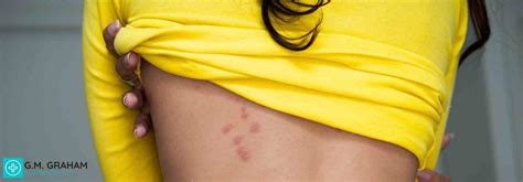 Infected Insect Bites Gm Graham Pharmacies