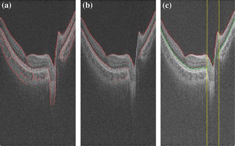 Automated Choroid Segmentation In Three Dimensional 1 μm Wide View Oct Images With Gradient And