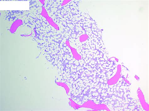 Hypocellular Bone Marrow Download Scientific Diagram