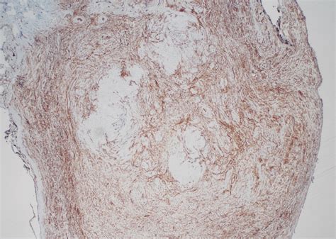 Hybrid Peripheral Nerve Sheath Tumor Rpathology