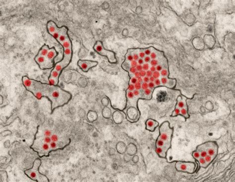 Zika Virus Vaccine Trial Launches Mdedge Infectious Disease