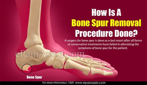 How Is A Bone Spur Removal Procedure Done