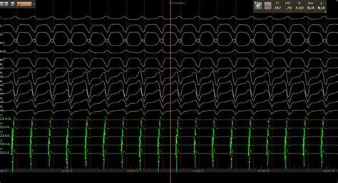 Donatella Ruggiero On Linkedin Left Ischemic Cartomap Team Pioxi