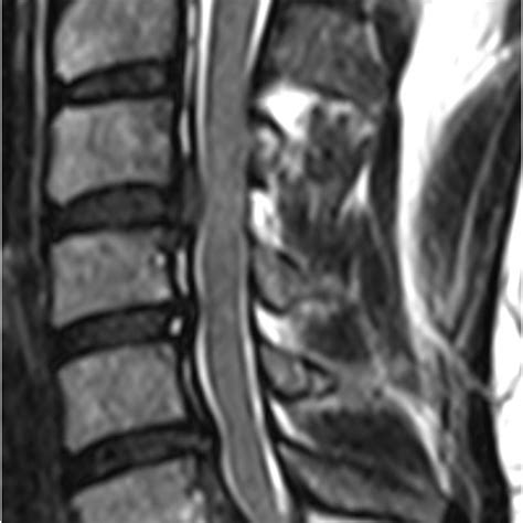 Preoperative Mri Of The Cervical Spine T2 Axial Sequence Demonstrating