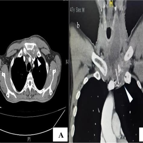 CECT Neck Axial Image Showing Well Defined Hypodense Lesion With A