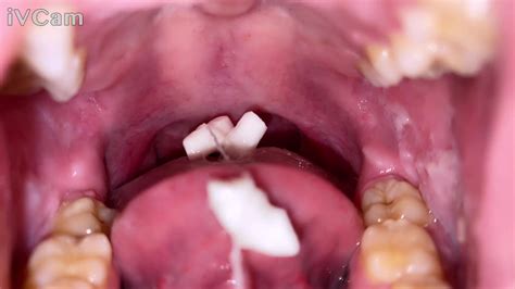 Swallowing Candies With String