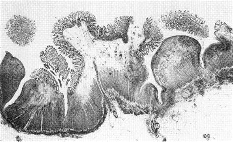 Figure From Crohn S Disease Abridged Semantic Scholar