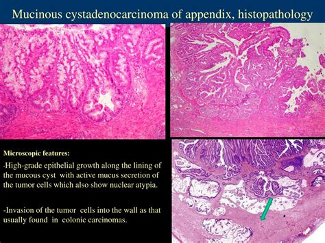 Ppt Diseases Of The Appendix Developmental Abnormalities