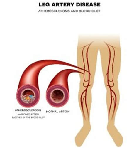 Leg Ulcer Treatment And Preventing Further Progression Of The Condition