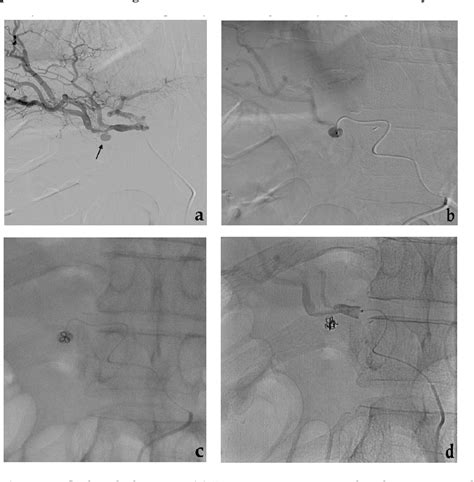 Figure 1 From Visceral Artery Aneurysms Embolization And Other