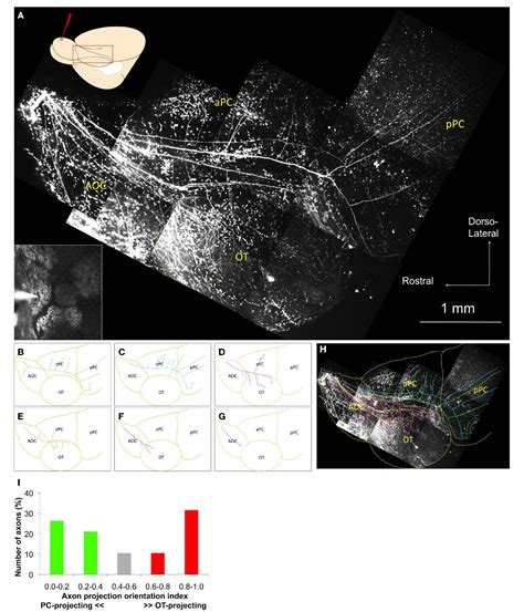 Anterolateral Myocardial Infarction Semantic Scholar