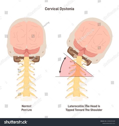 Cervical Dystonia Spasmodic Torticollis Inflamatory Condition Stock