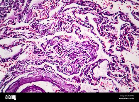 Histopathology Of Smoker S Lung Light Micrograph Showing Accumulation