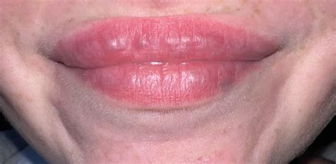 Lumps In Lip 5 Months Post Filler Normal Rplasticsurgery