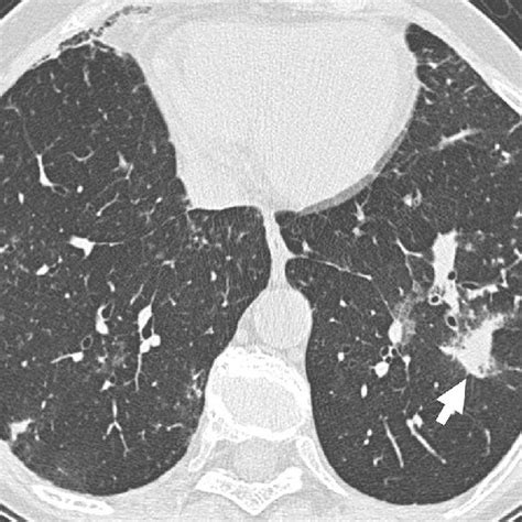 Cellular Nsip Pattern The Multiplanar Axial A And Coronal B Download Scientific Diagram