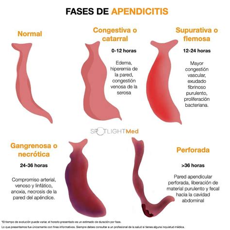 Taburete Circunstancias Imprevistas Pizarra Señales De Apendicitis