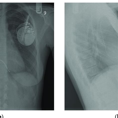 The Cxr Was Performed After The Icd Implantation In 2010 The Image
