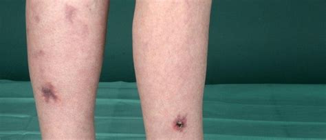 Erythema Induratum Nodular Vasculitis Erythema Nodosum