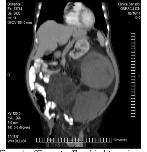 Figure 1 From A Rare Case Of A Giant Retroperitoneal Recurrent
