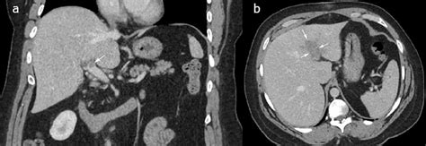 Elizabeth Lorbeer On Linkedin Prothrombin Gene Mutation As A Teaching Tool An Autobiographical