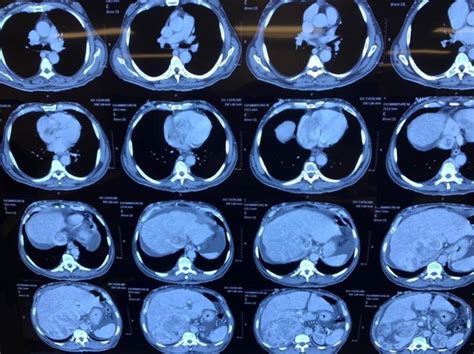 Malignant Pheochromocytoma With Intravascular Extension To The Heart Ochsner Journal