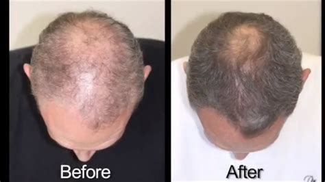 Hair Loss Treatment For Men With Advanced Trichology Youtube