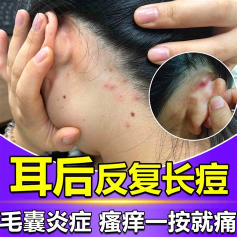 耳朵里长粉刺怎么办 头发长虱子怎么办 大山谷图库