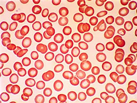 Eritrocitos Anemia