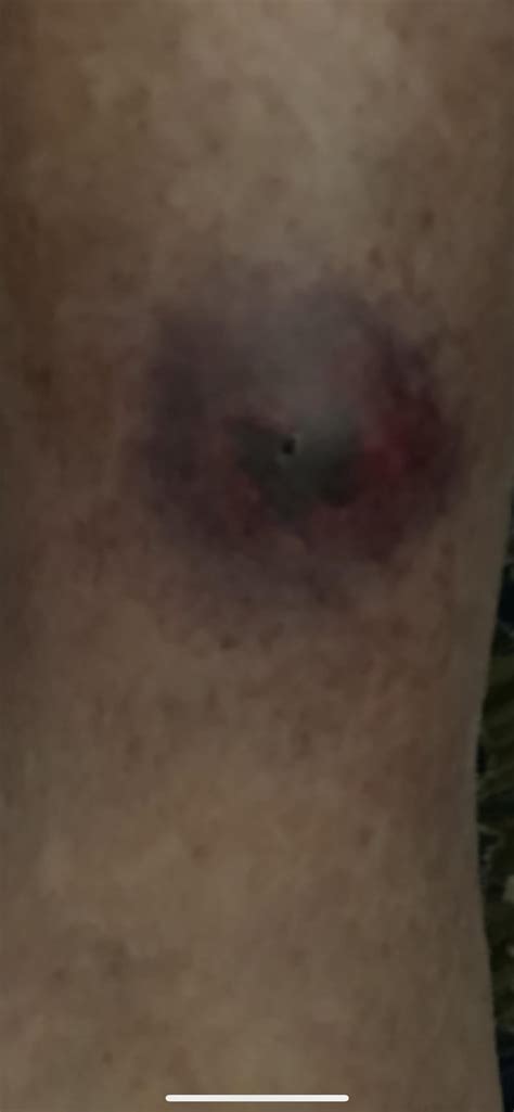 Possible Spider Bite Or Abscess Rdiagnoseme