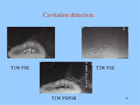 Ppt High Intensity Focused Ultrasound Hifu Guided By Mri