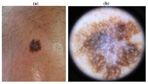 Cancerous Scalp Lesions