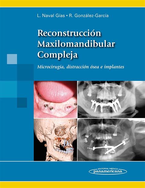 Buy Reconstrucción Maxilomandibular Compleja Reconstruction