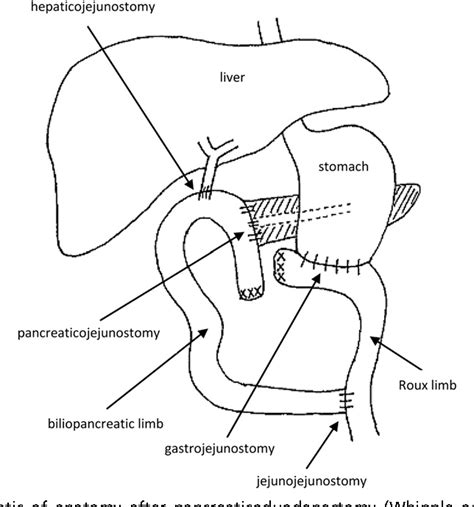 Gastrojejunostomy Hepaticojejunostomy