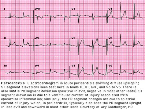 Ecg Pericarditis