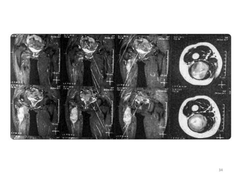 Malignant Peripheral Nerve Sheath Tumours M E Elsebaeypdf