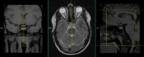 Pituitary MRI Protocols Planing And Indications Pituitary Dynamic