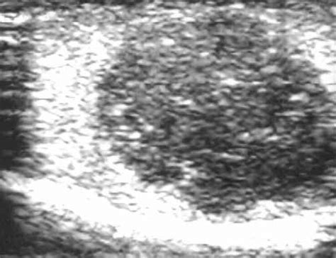 Sonogram Of The Left Testis Reveals A Heterogenous Hypoechoic Solid