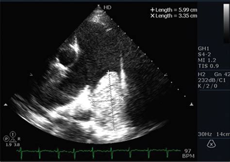 Peripartum Cardiomyopathy In South Indian Women—challenges And Outcomes