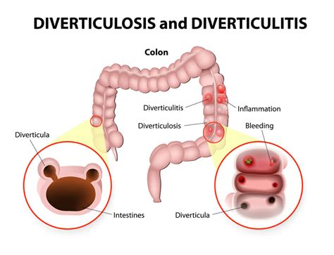 Diverticulitis Atlanta Ga Large Intestine Surgery Atlanta Ga