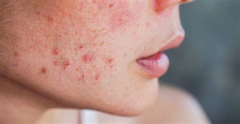 Study Confirms Spironolactone Safe And Effective For Treating Acne In