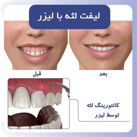 لیفت لثه با لیزر چیست؟ 7 مزیت نسبت به جراحی سنتی دکتر سیده مریم حاکم زاده