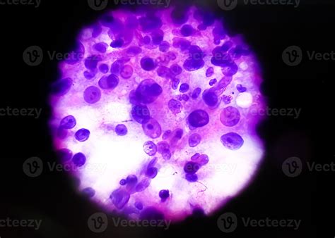 étude Cytologique Dune Masse Intra Abdominale Sarcome à Cellules