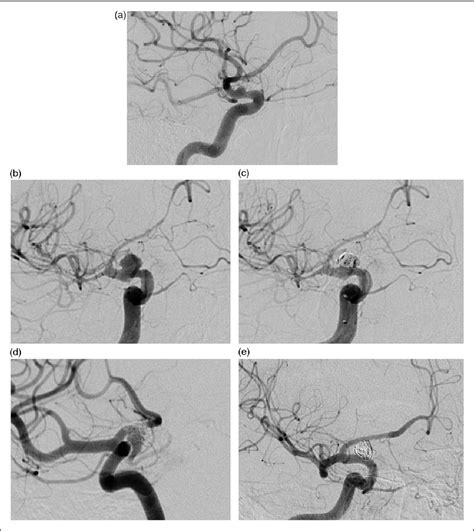 Figure 1 From Treatment Of Ruptured Blood Blister Aneurysms Using
