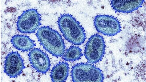 აფრიკის გარეთ “მაიმუნის ყვავილის” 780 შემთხვევა დადასტურდა გურიის მოამბე