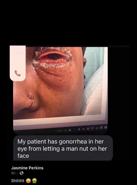 Gonorrhea Eye Conjunctivitis Description Causes Symptoms