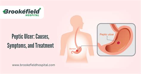 Peptic Ulcer Causes Symptoms And Treatment Brookefield Hospital